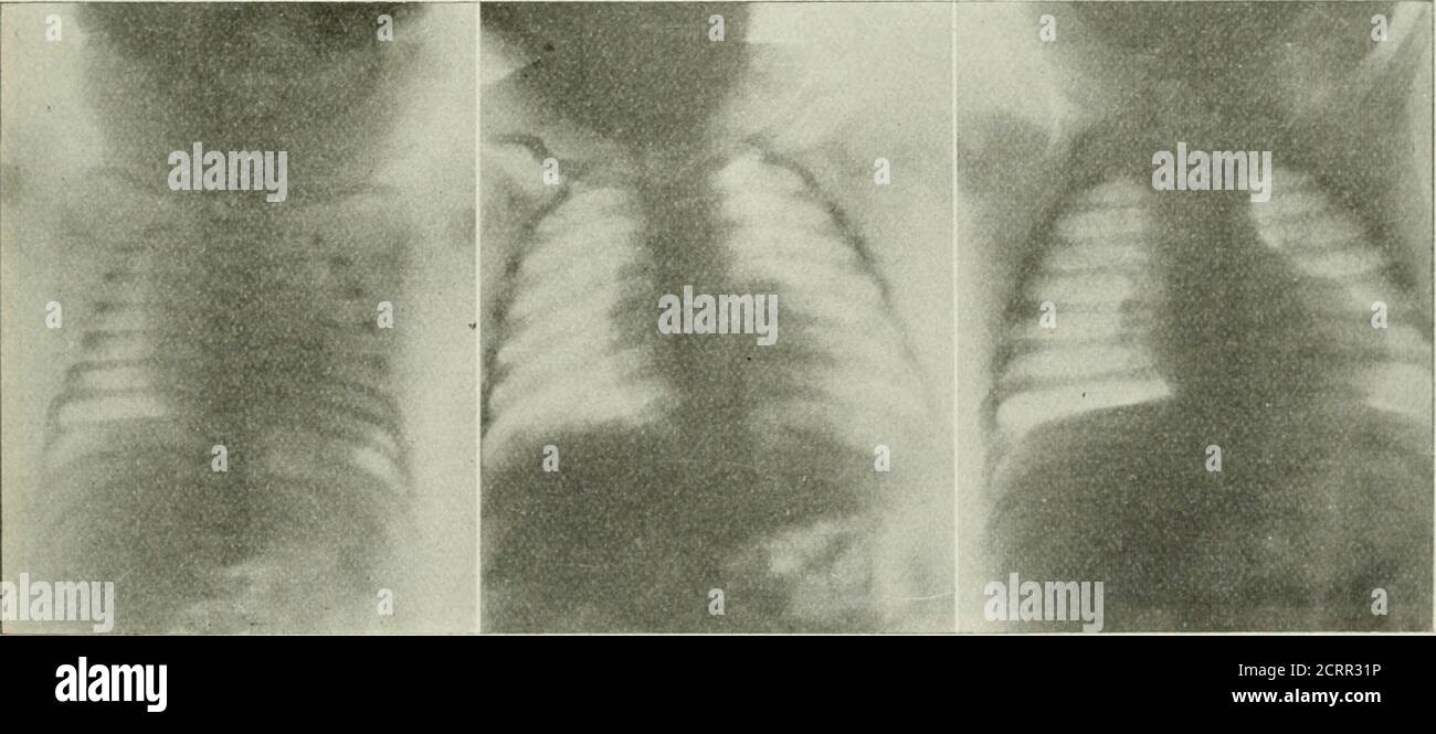 . Radium . Fig-. 1. Illustrating Bulging of Anterior andUpper Chest and ...