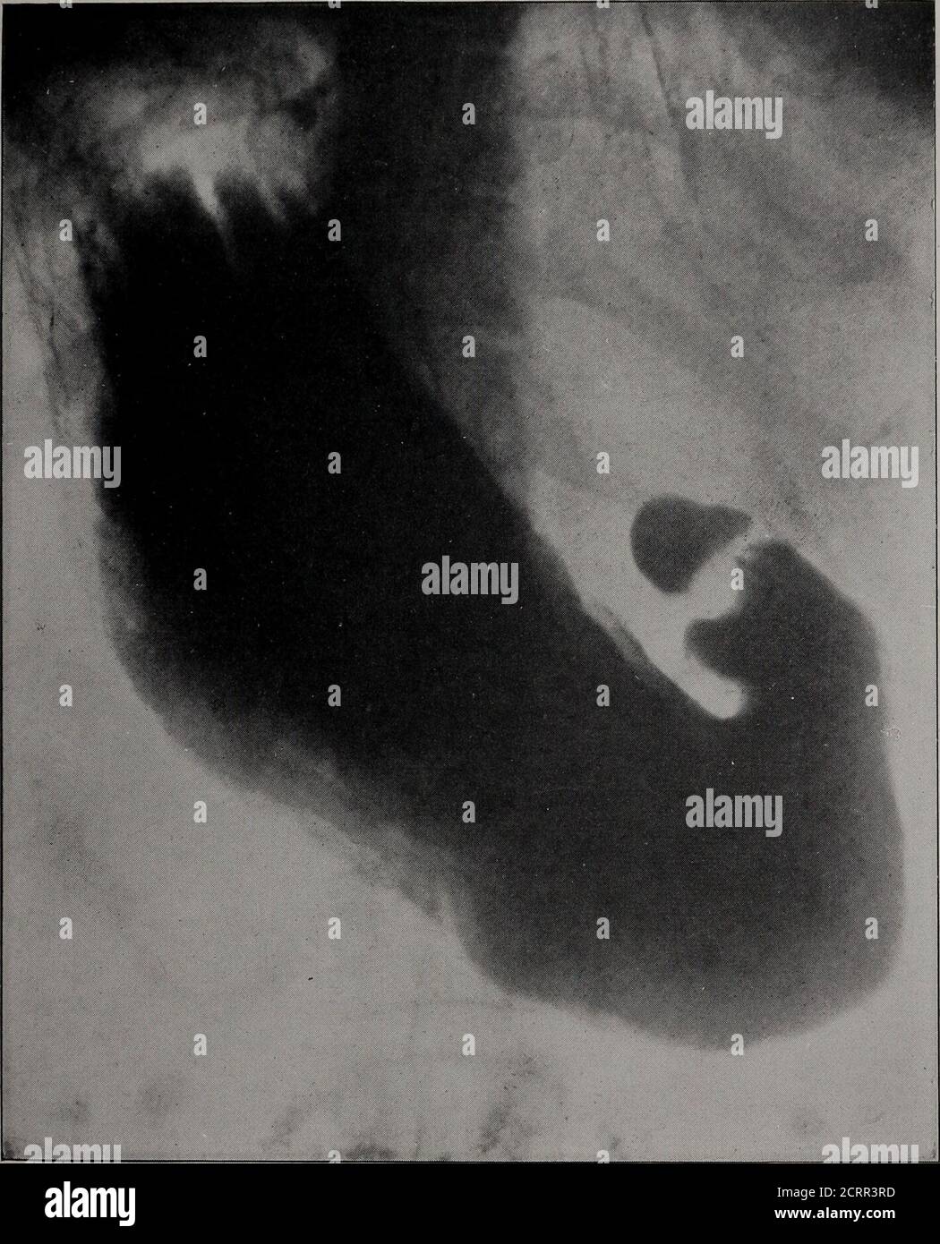 Duodenal cap hi-res stock photography and images - Alamy