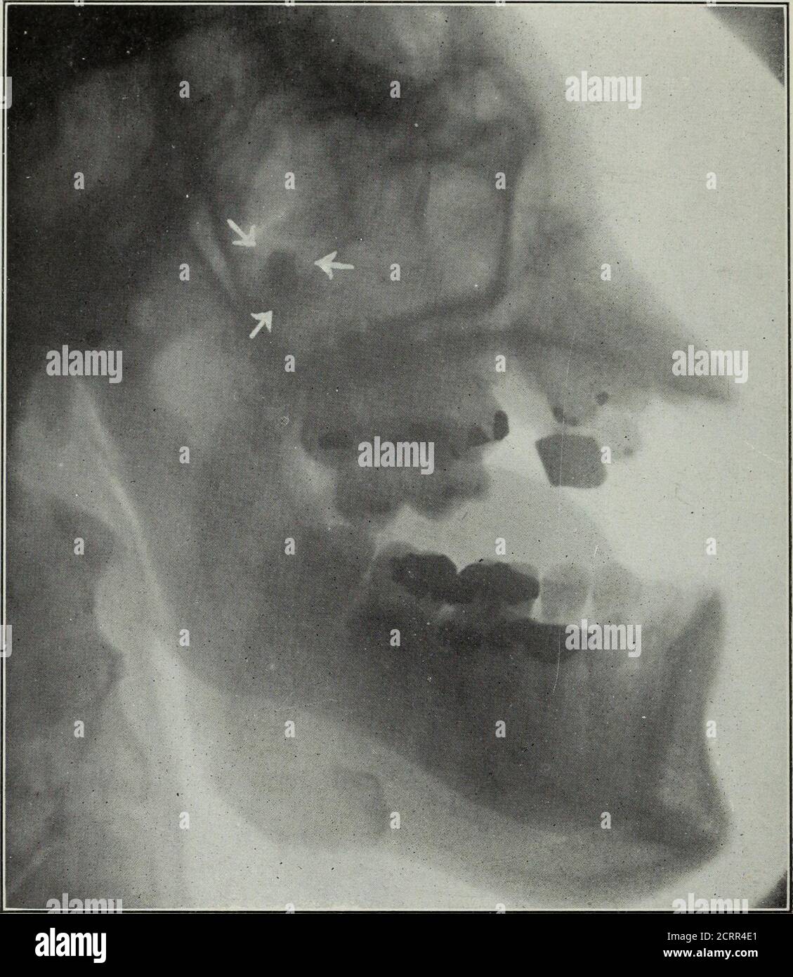 . Elementary and dental radiography . Fig. 276. The dots outline a very ...