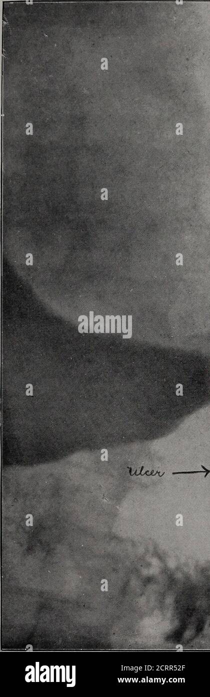 Sacculation hi-res stock photography and images - Alamy