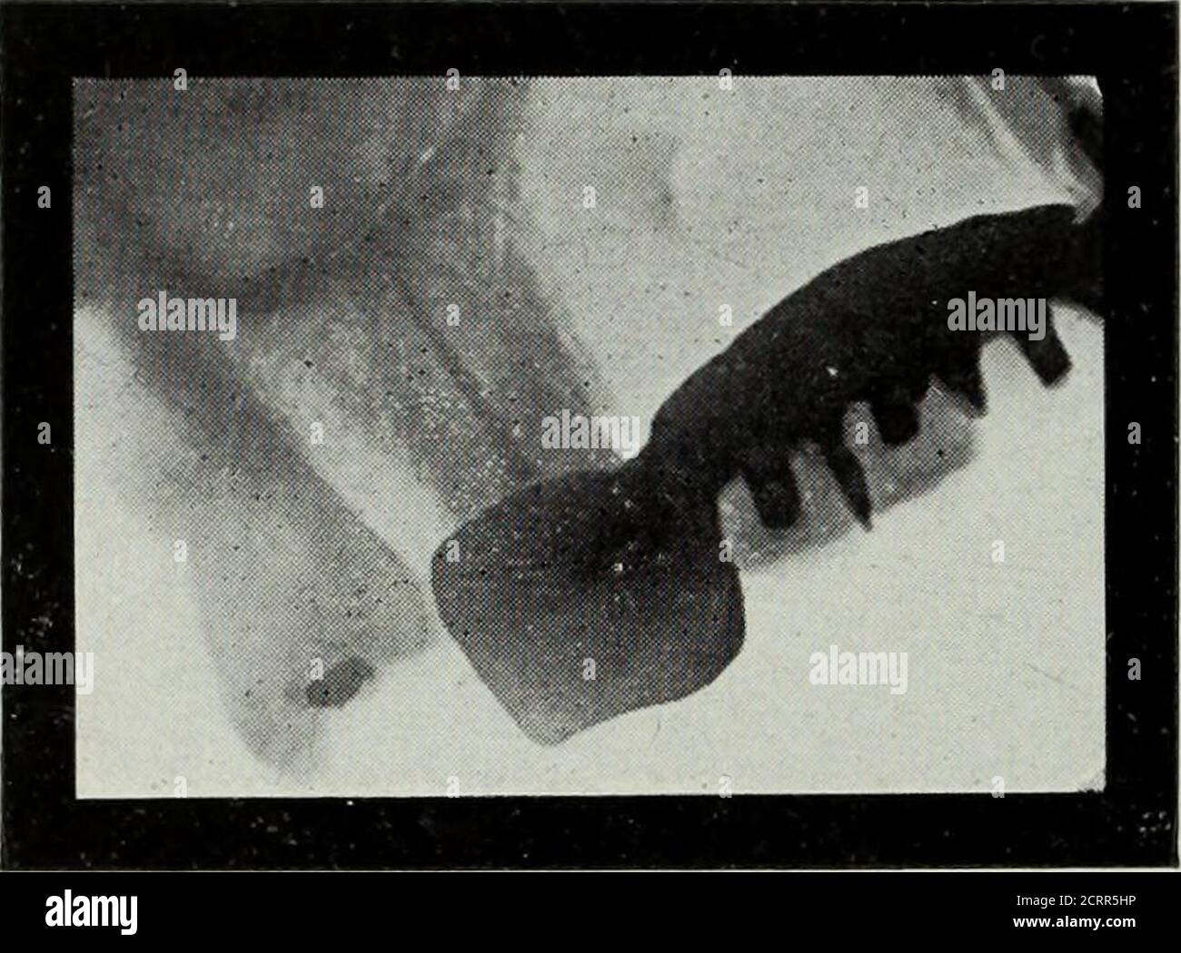 Superior maxillary bone hi-res stock photography and images - Alamy