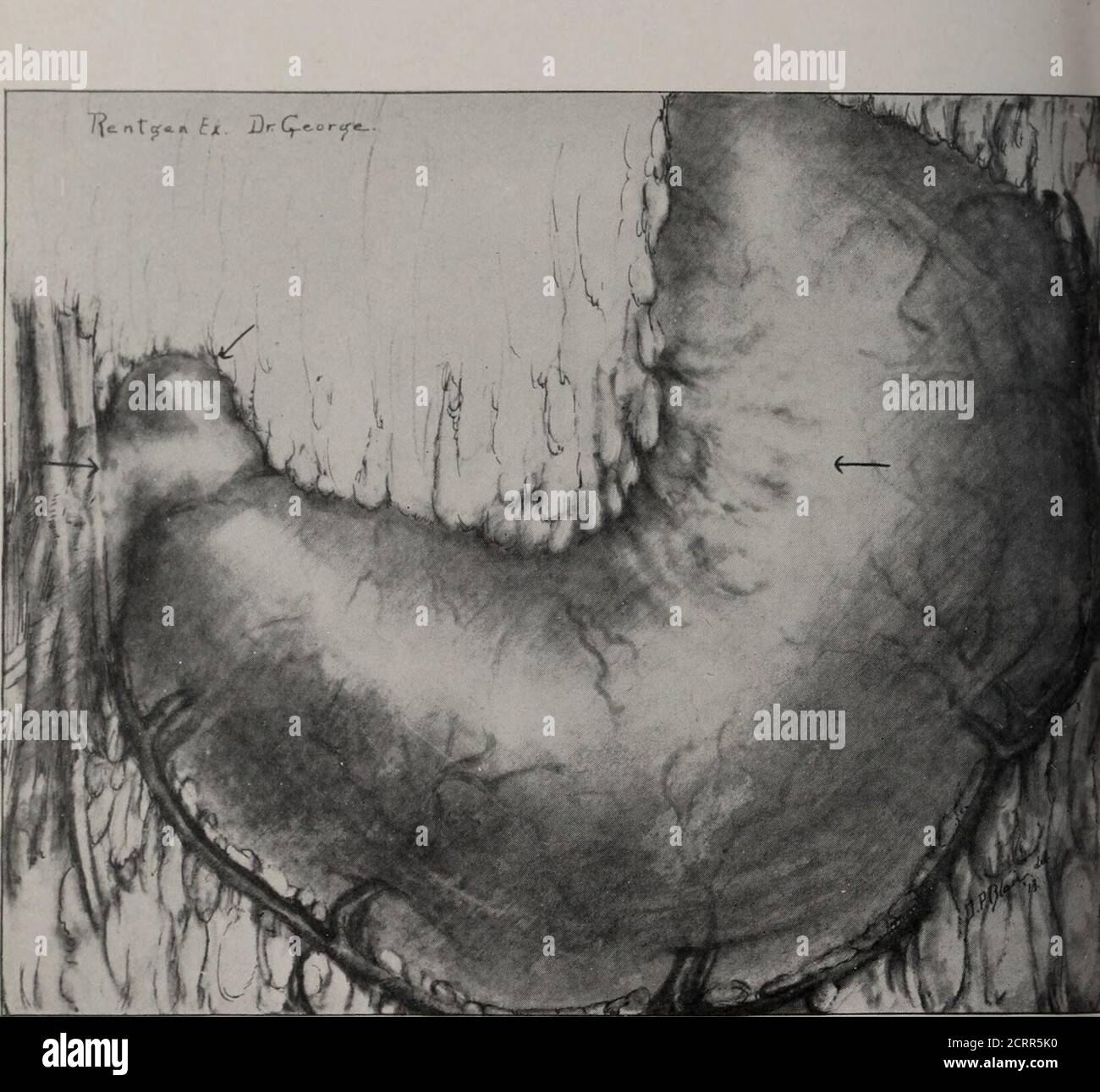 . American quarterly of roentgenology . Fig. 7. Same case, lateral view ...