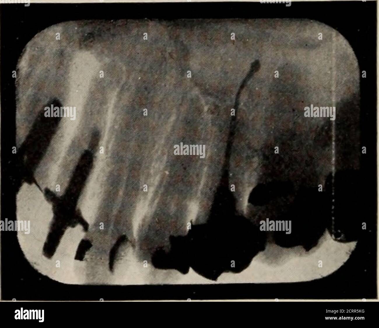Root canal filling material hi-res stock photography and images - Alamy