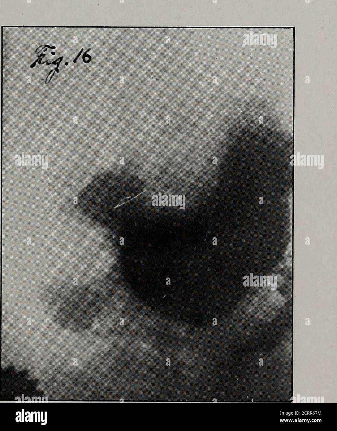 Pyloric stenosis hi-res stock photography and images - Alamy