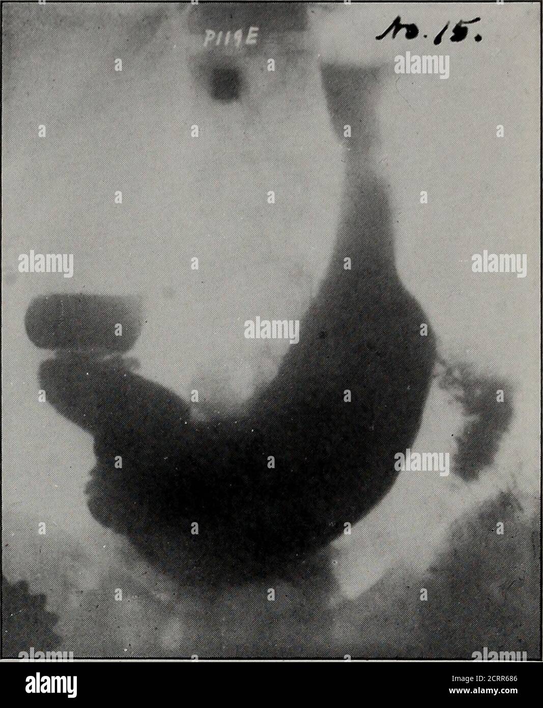 Duodenal stenosis hi-res stock photography and images - Alamy