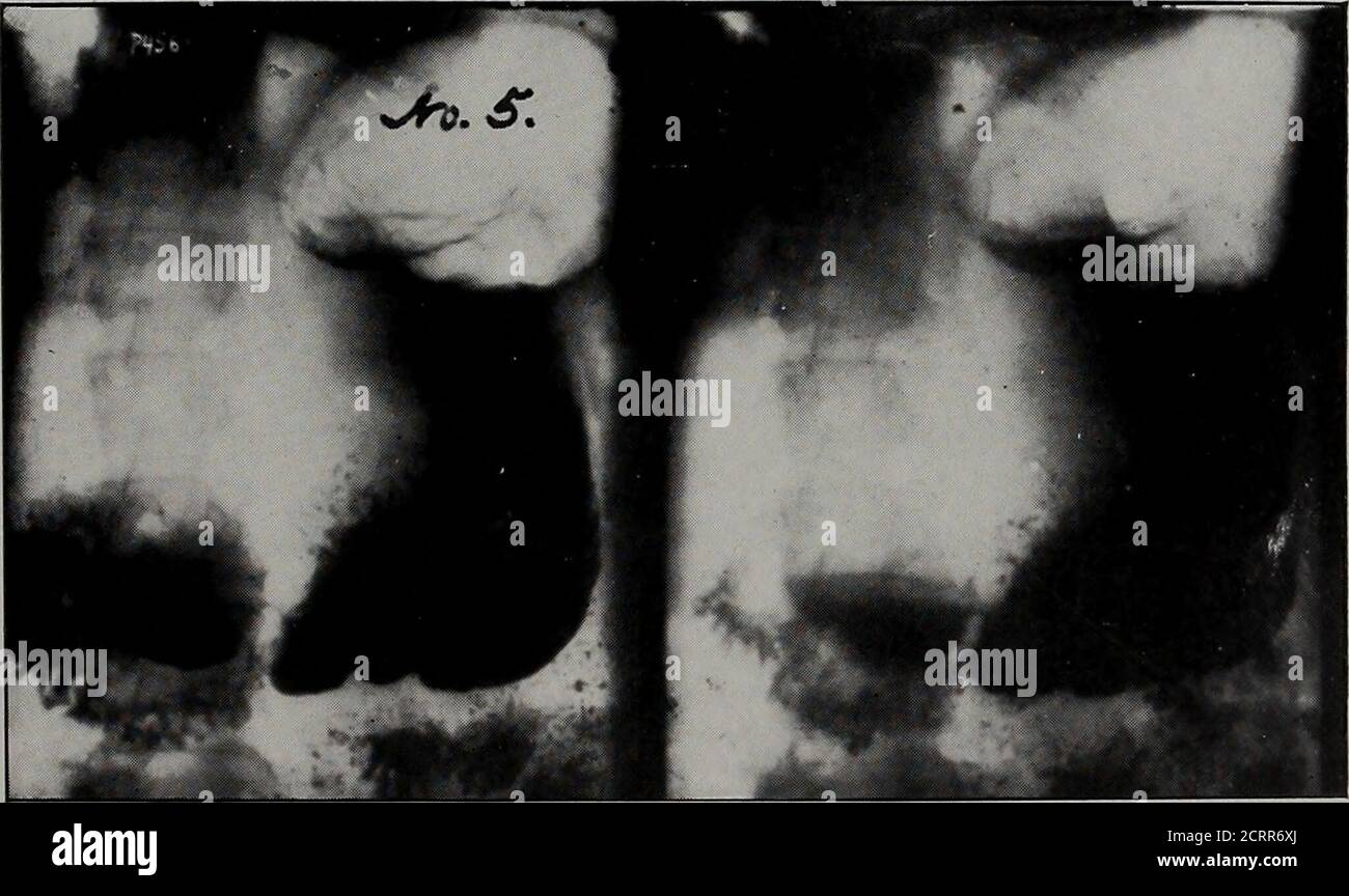 . American quarterly of roentgenology . Fig. 4. Spasmodic hour-glass ...