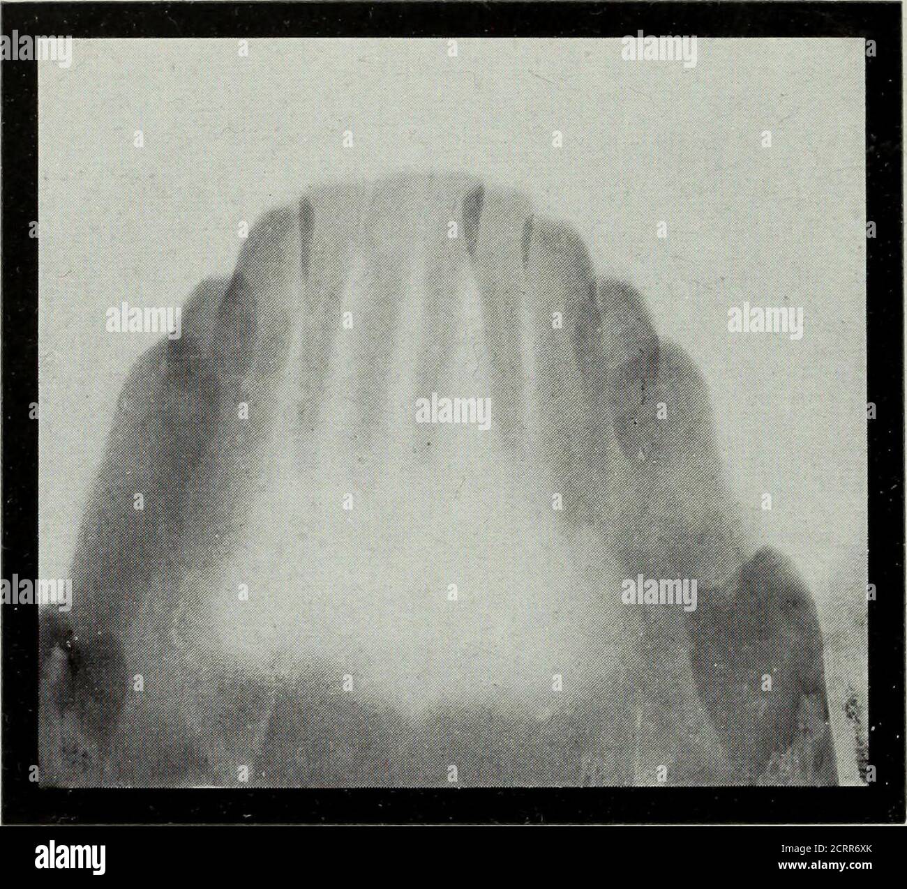. Elementary and dental radiography . epresents the cyst. This radio ...