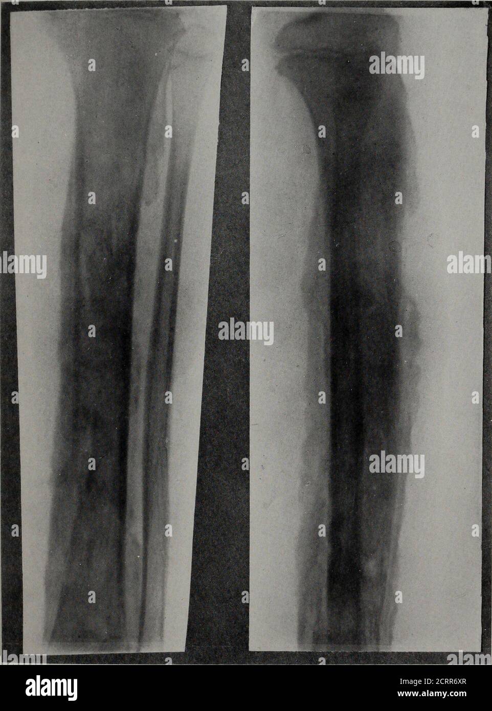 . American quarterly of roentgenology . Fig. 1. Case 11. Tuberculous ...