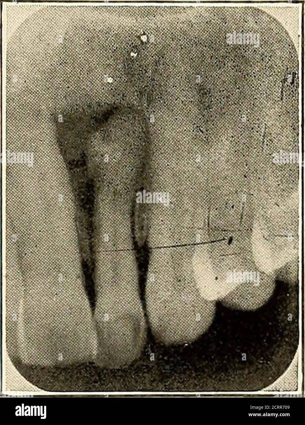 Extra incisor hi-res stock photography and images - Alamy