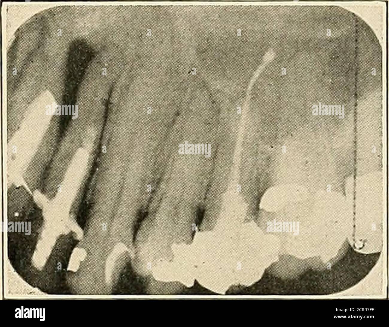 Root canal filling material hi-res stock photography and images - Alamy
