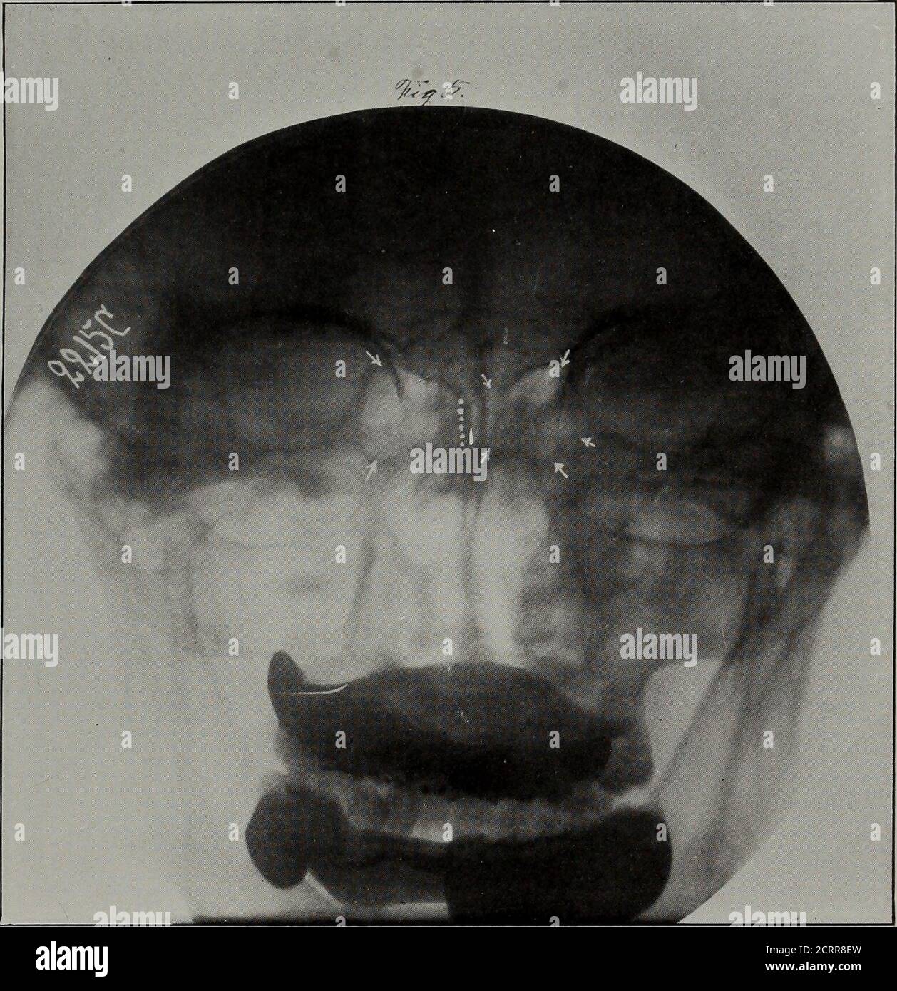 . American quarterly of roentgenology . Fig. 4.—Lateral view in living ...