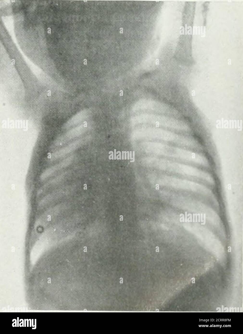 Lung middle lobe hi-res stock photography and images - Alamy