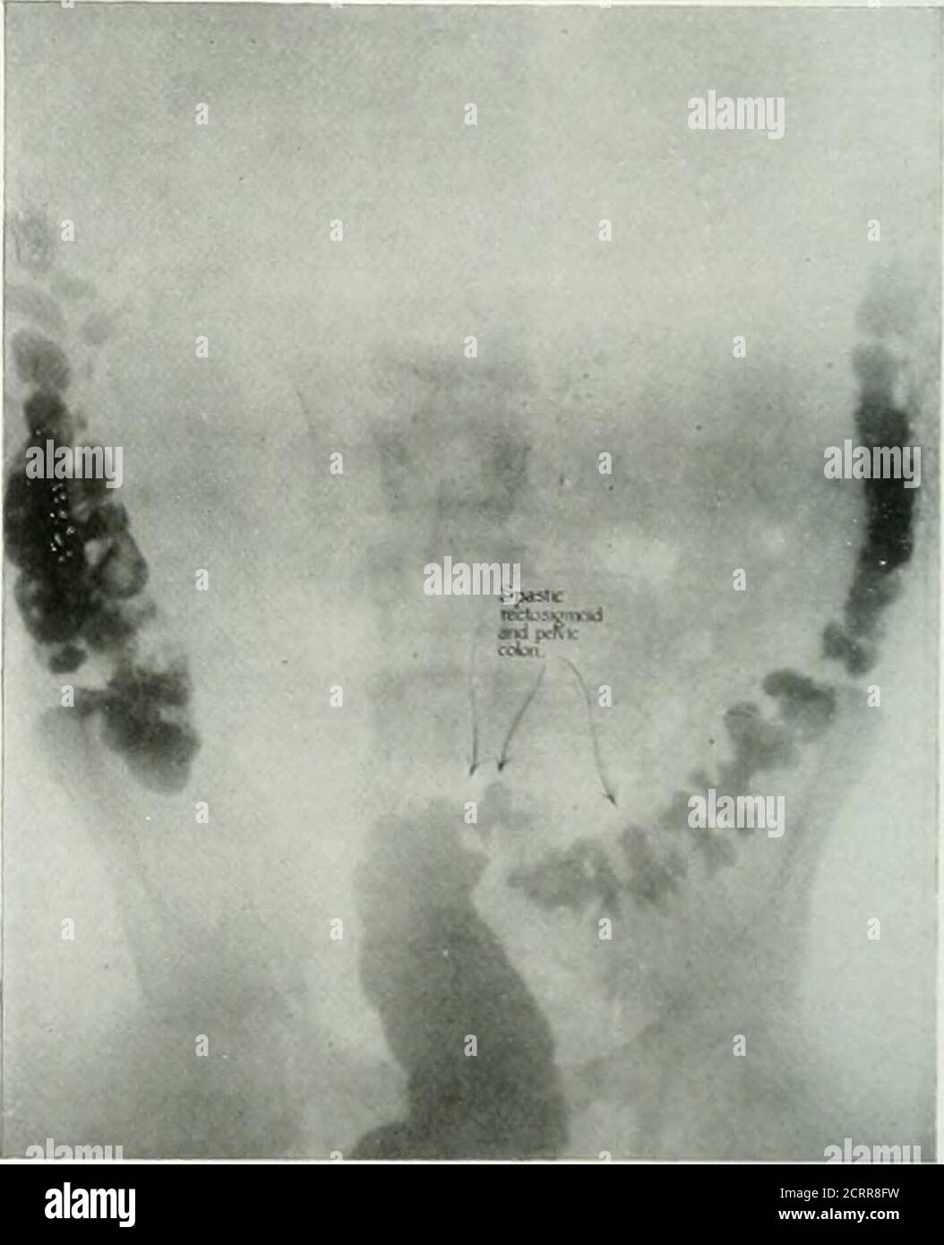 . The American journal of roentgenology, radium therapy and nuclear ...