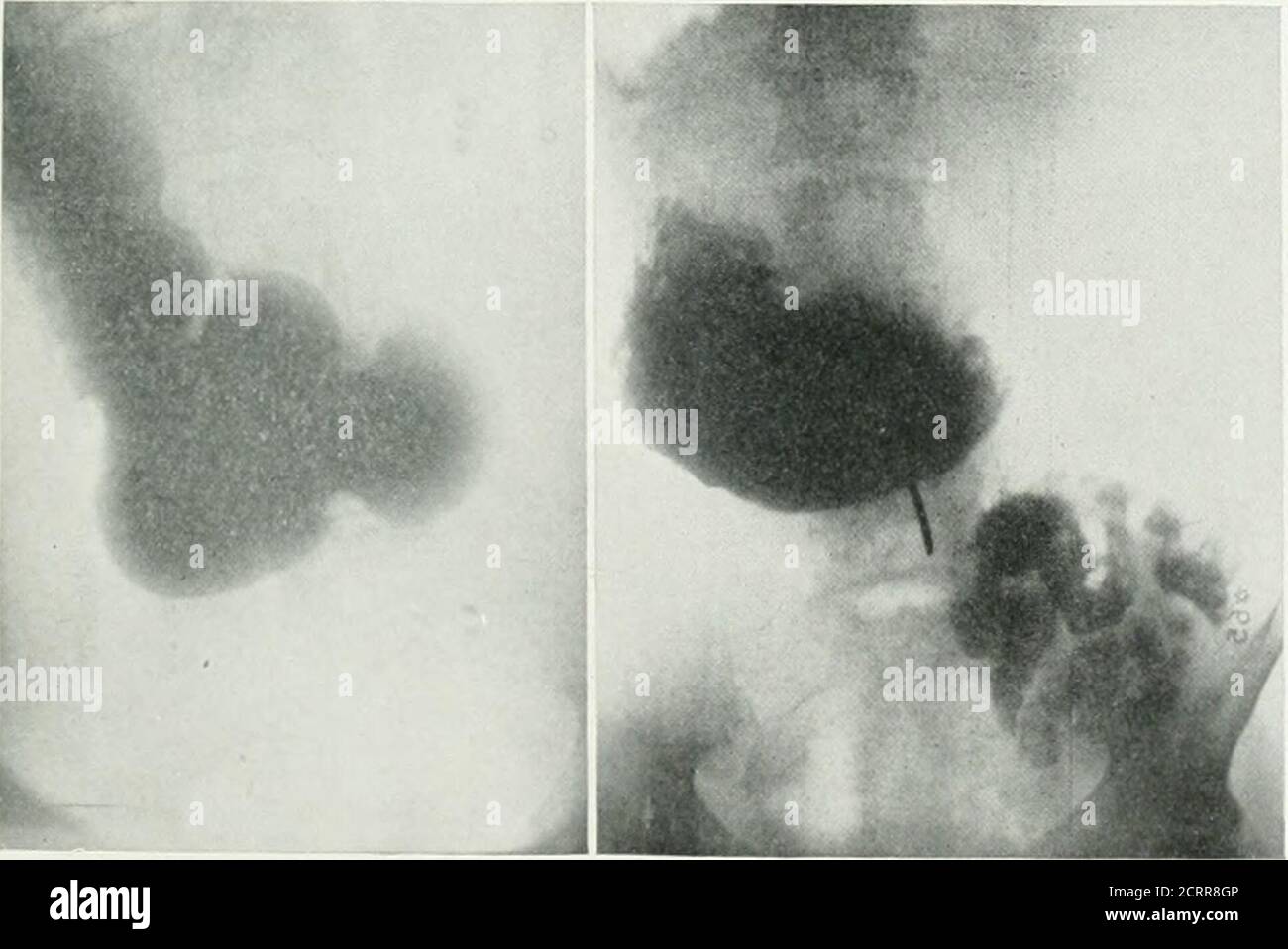 Fat in abdominal cavity hi-res stock photography and images - Alamy