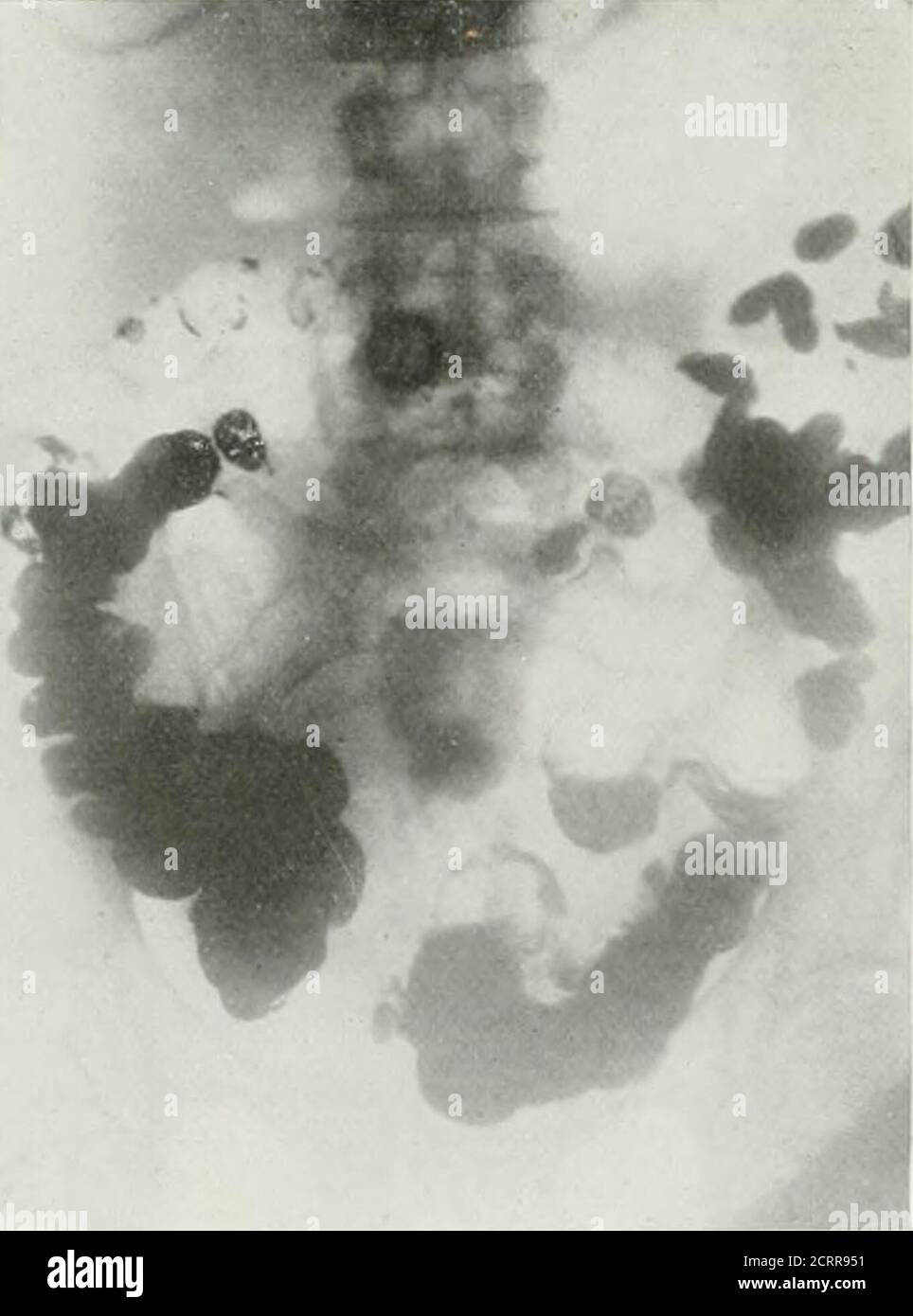 Appendicitis x ray hi-res stock photography and images - Alamy