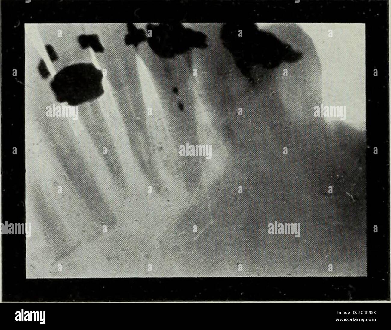 Alveolar abscess hi-res stock photography and images - Alamy