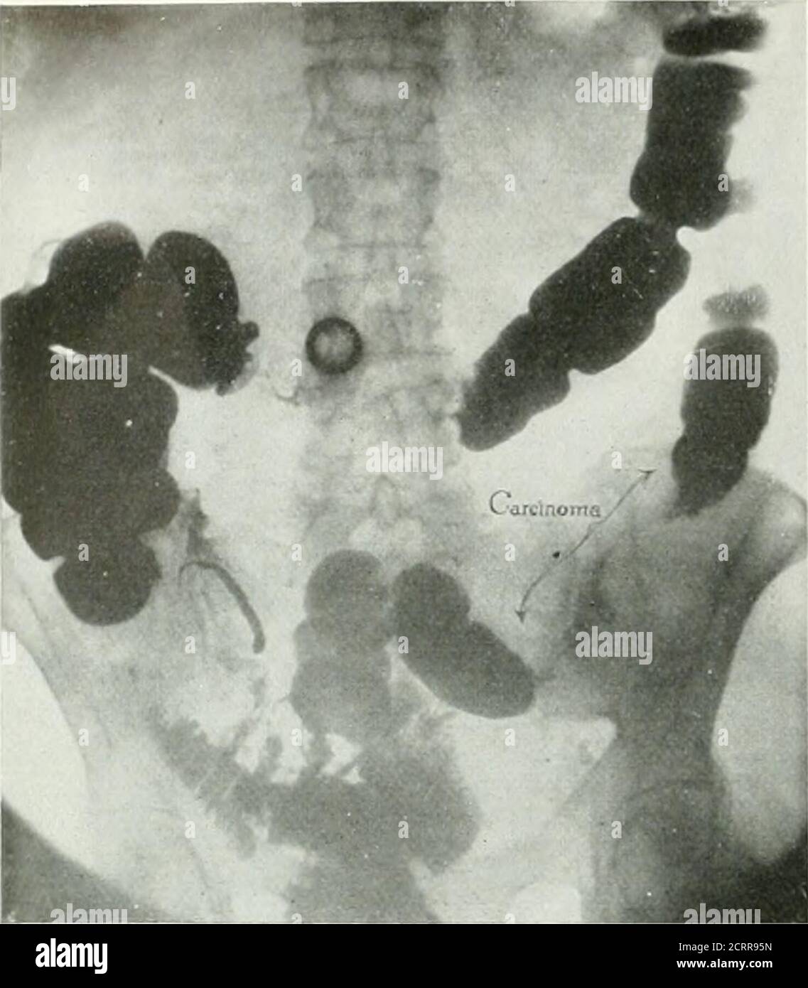 Diverticulitis intestinal hi-res stock photography and images - Alamy