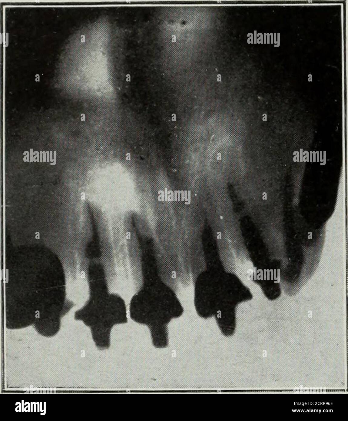 . Elementary and dental radiography . apex of a tooth carrying acrown ...