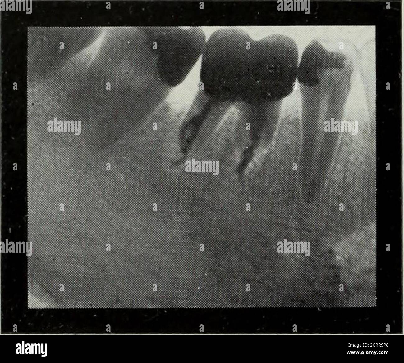 Alveolar bone destruction hi-res stock photography and images - Alamy