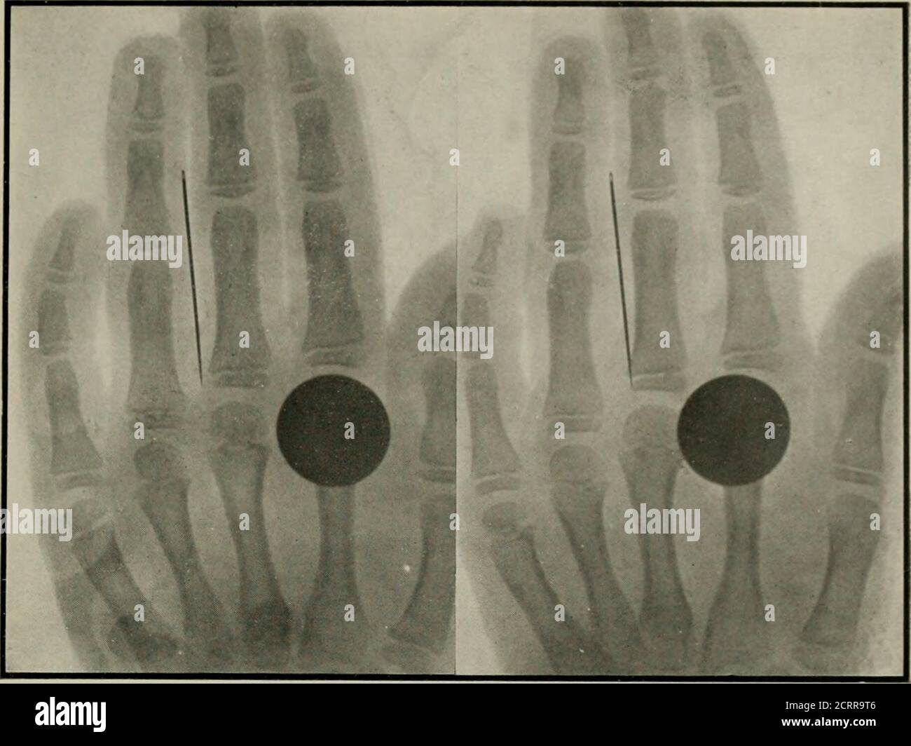 Coin radiography hi-res stock photography and images - Alamy
