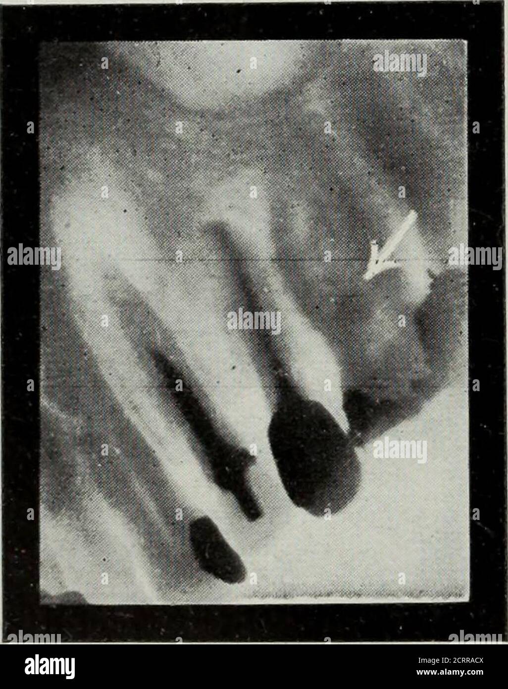 . Elementary and dental radiography . Fig. 175. The upper arrow points ...