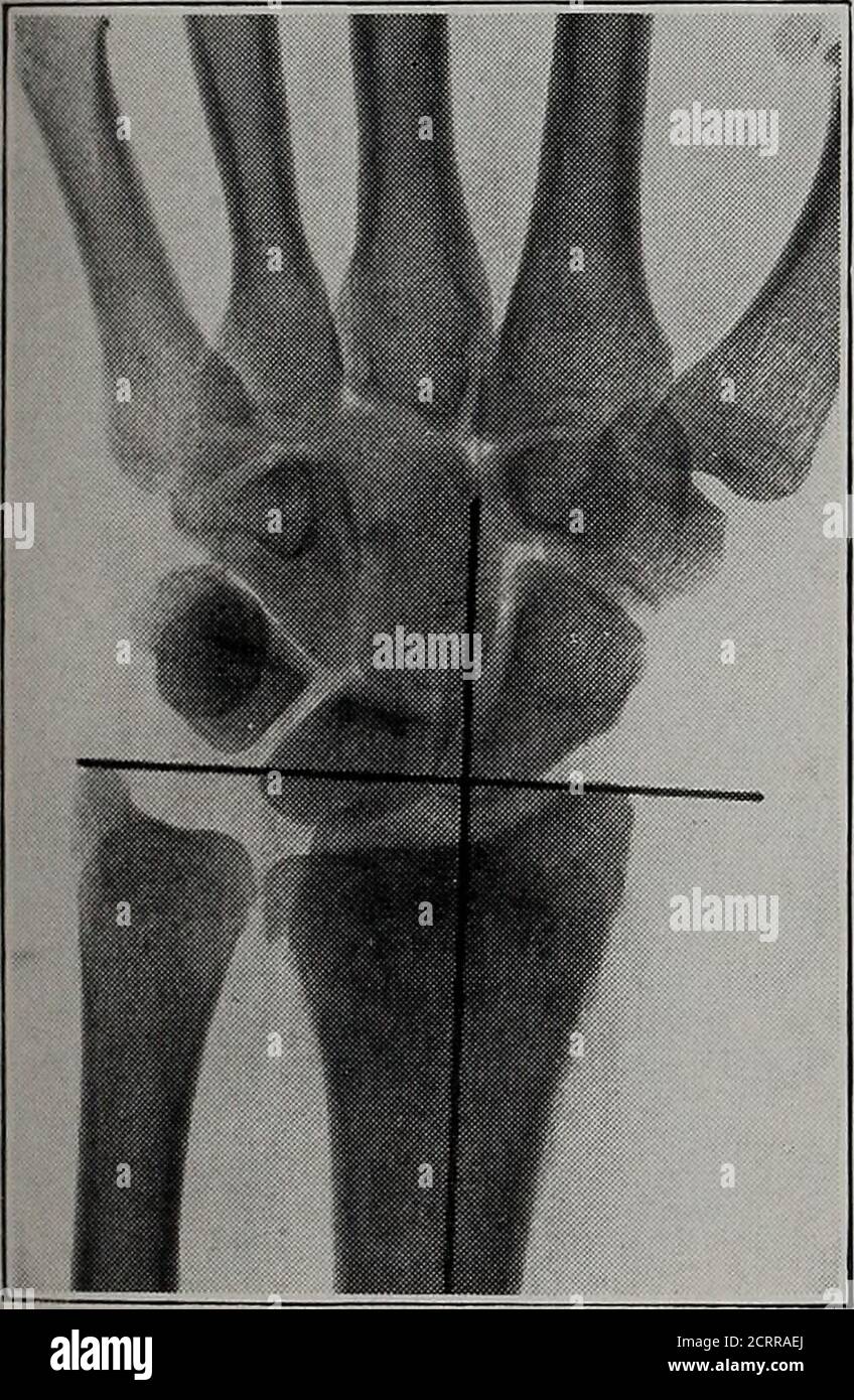 Radial styloid hi-res stock photography and images - Alamy