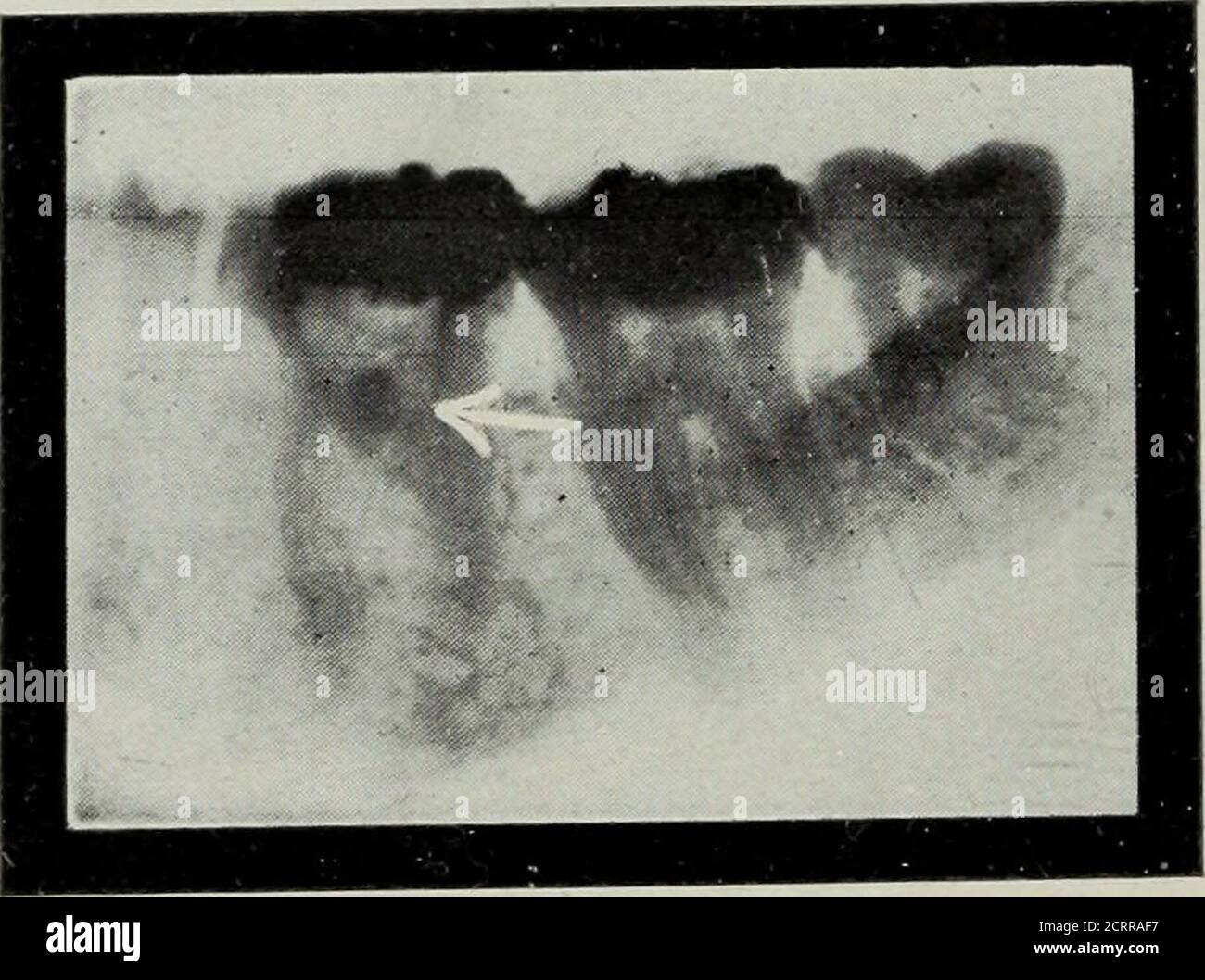 . Elementary and dental radiography . Fig. 176 Fig. 177 Fig, 176. The ...