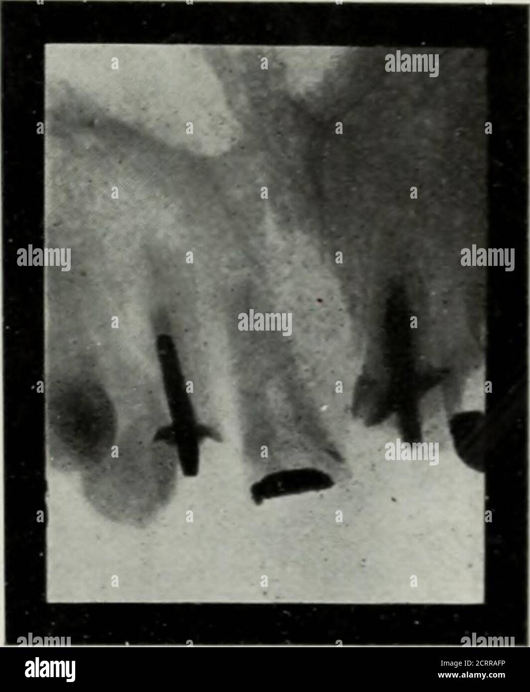 Foramen apical hi-res stock photography and images - Alamy