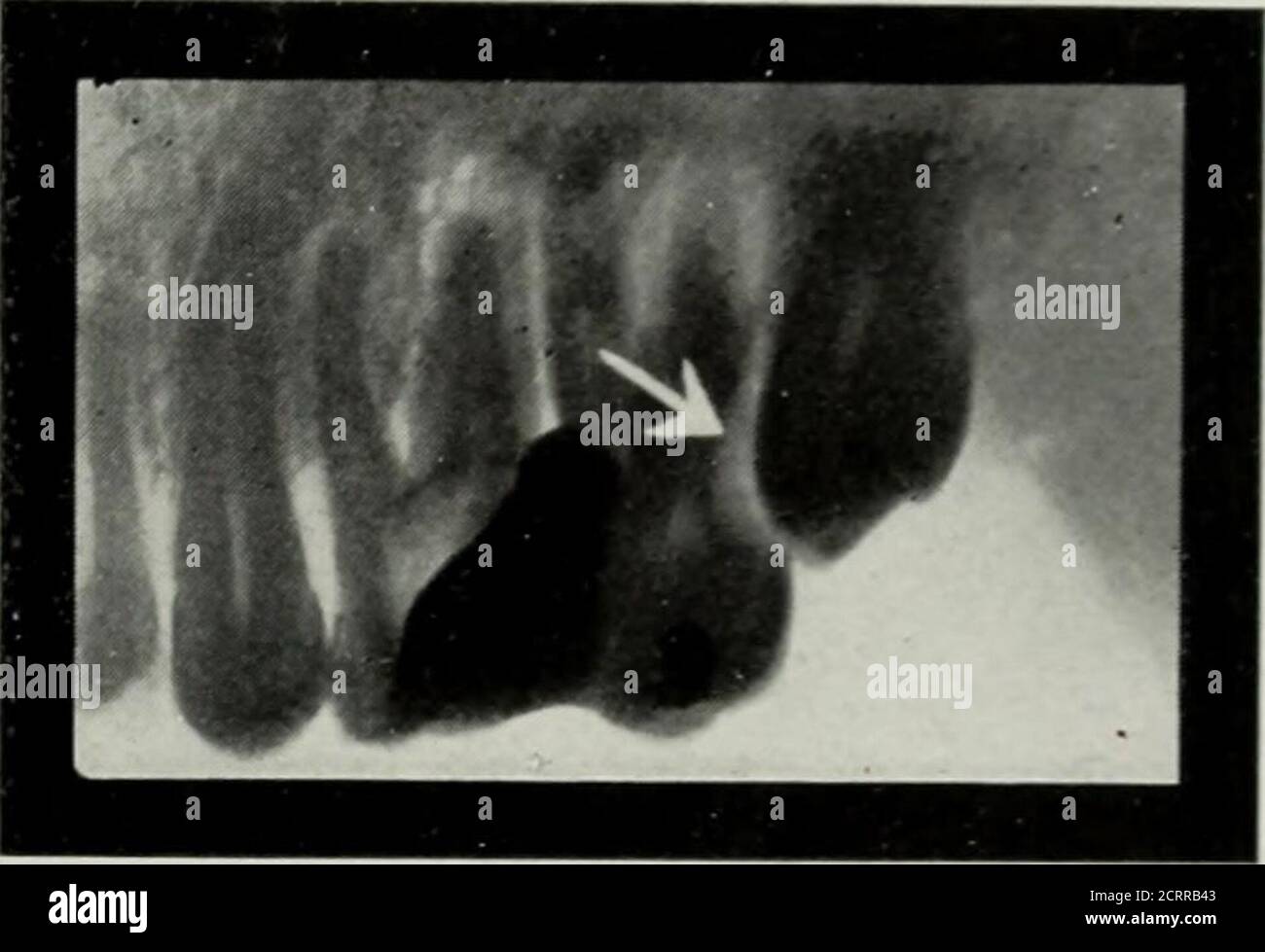 . Elementary and dental radiography . Fig. 157. Fig. 158. Fig. 157. An ...