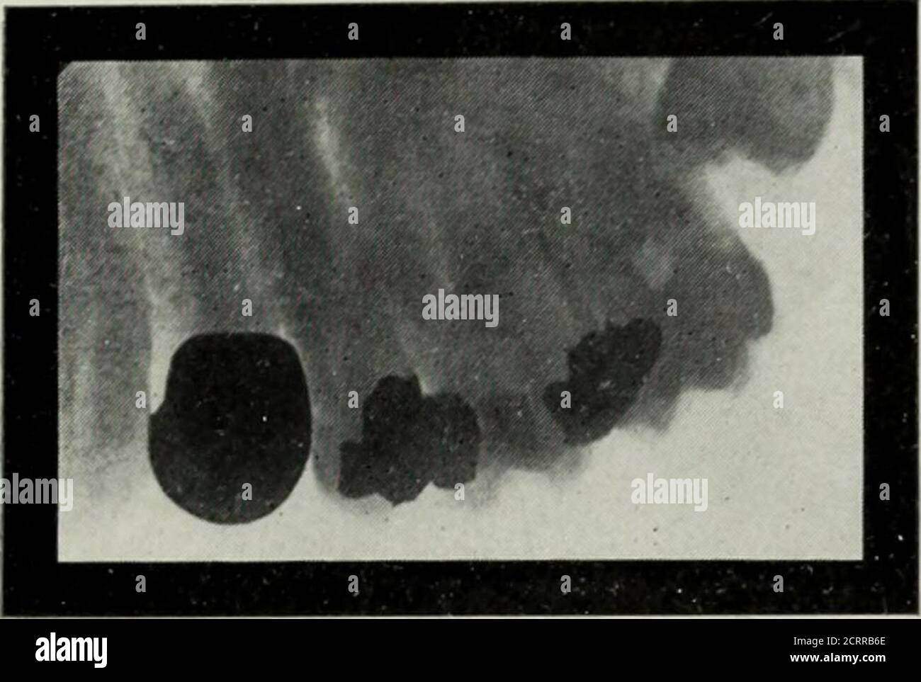. Elementary and dental radiography . Fig. 159. Impacted upper and ...