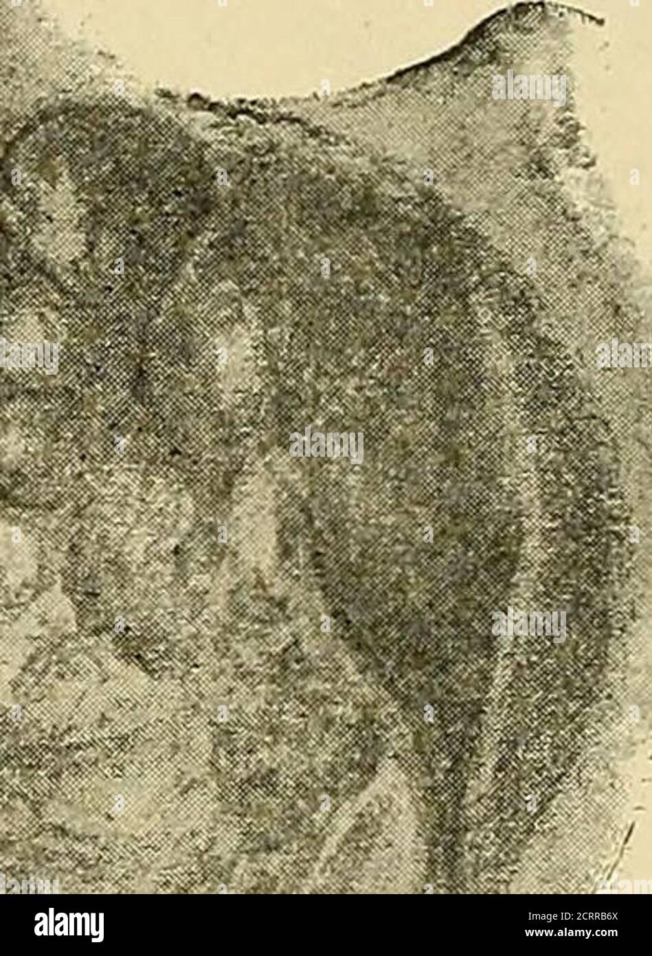 Wound secretion hi-res stock photography and images - Alamy