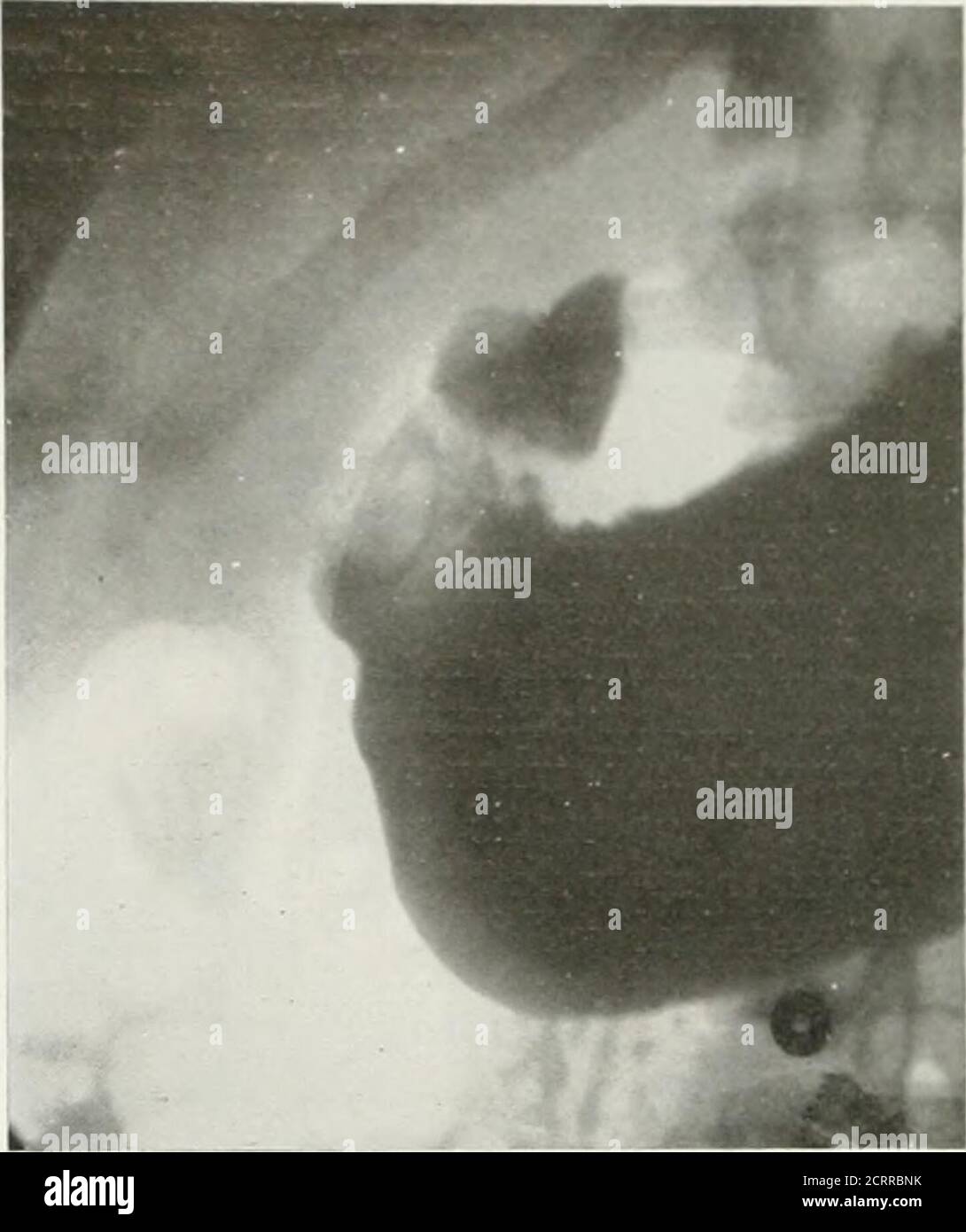 Hepatic flexure hi-res stock photography and images - Alamy