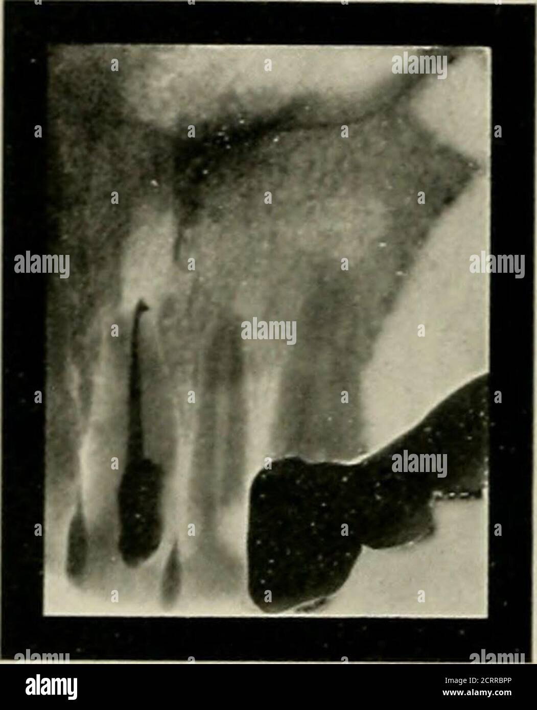 . Elementary and dental radiography . lower third molar, causing a ...