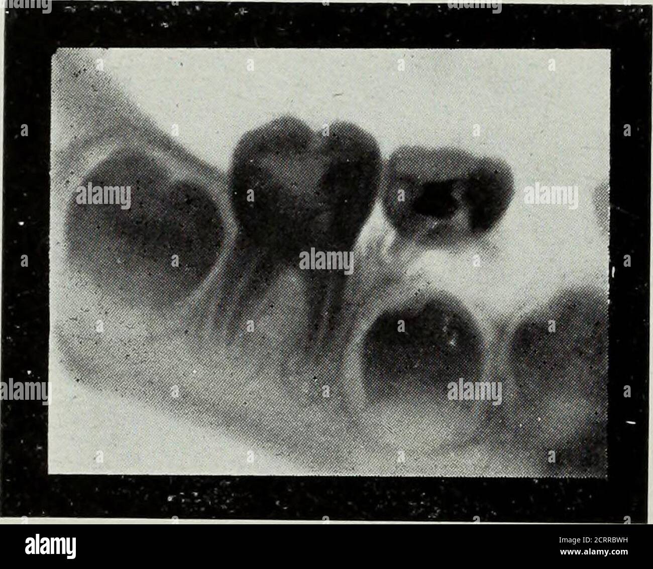 . Elementary and dental radiography . of the impacted cuspid. The ...