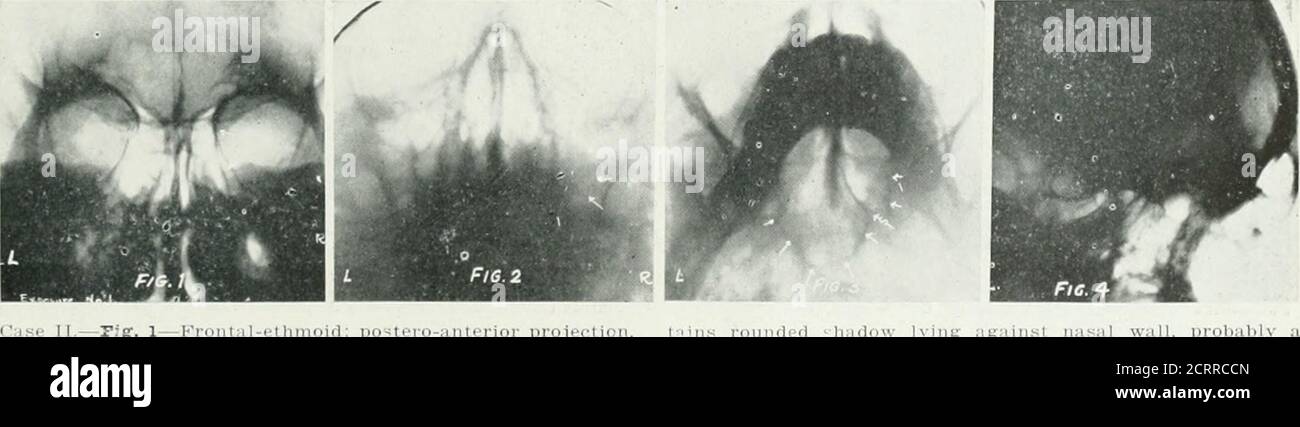 . Archives of physical medicine and rehabilitation . Ca=e I.—Fig-. 1 ...