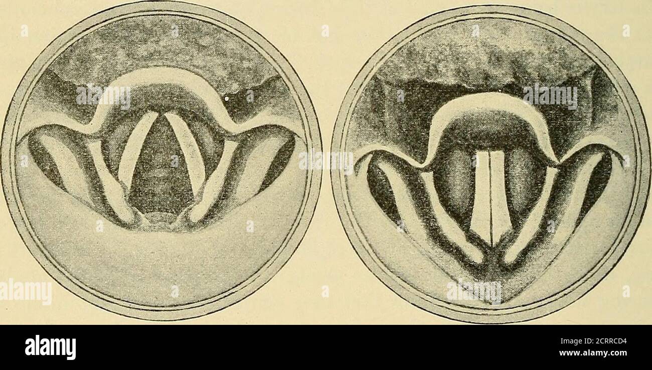 . Diseases of the nose and throat . effort, invariabty, the wider will ...