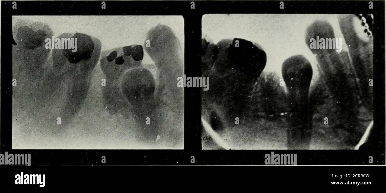 . Elementary and dental radiography . case. Fig. 140 is a radiograph of ...