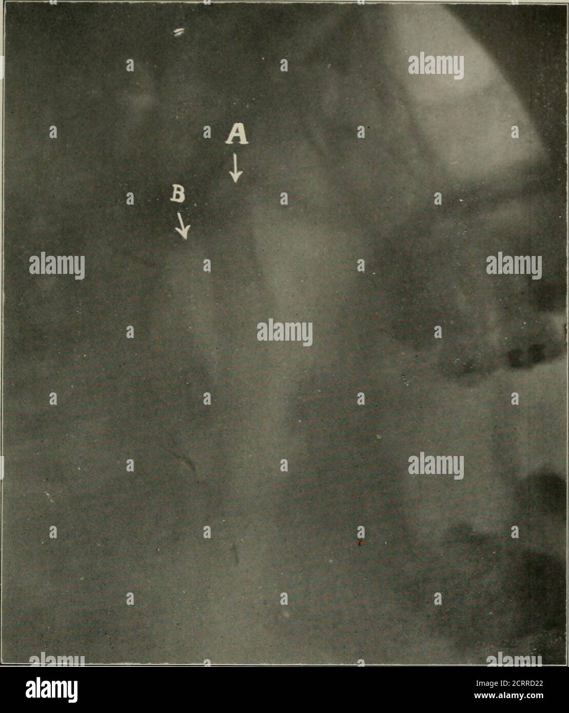 . Elementary and dental radiography . fromsubject. (Radiograph by ...