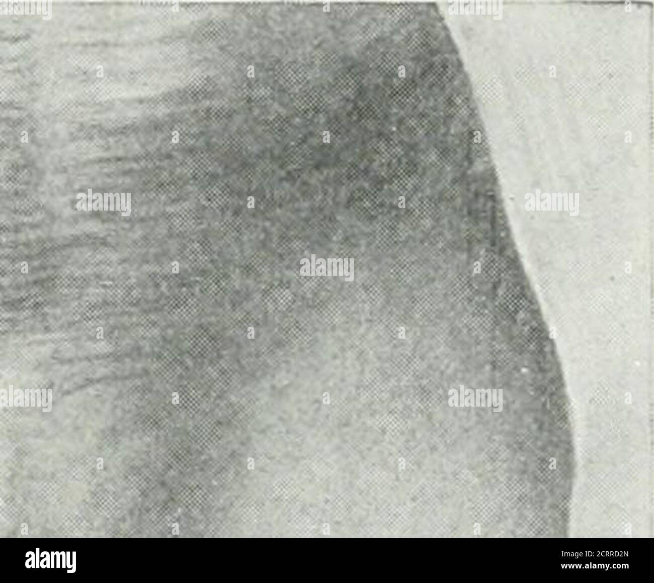 . Radium . Fig. 14.—Radium needles in position. ary disturbance beyond ...