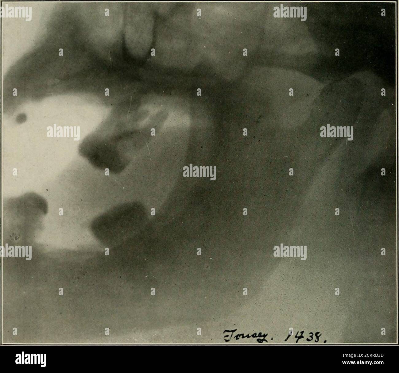 Mandibular dislocation hi-res stock photography and images - Alamy