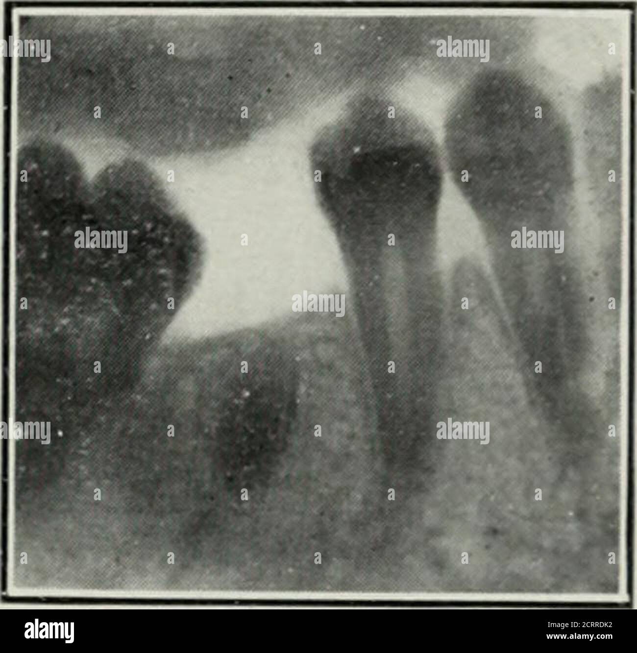 Maxillary radiographs hi-res stock photography and images - Alamy