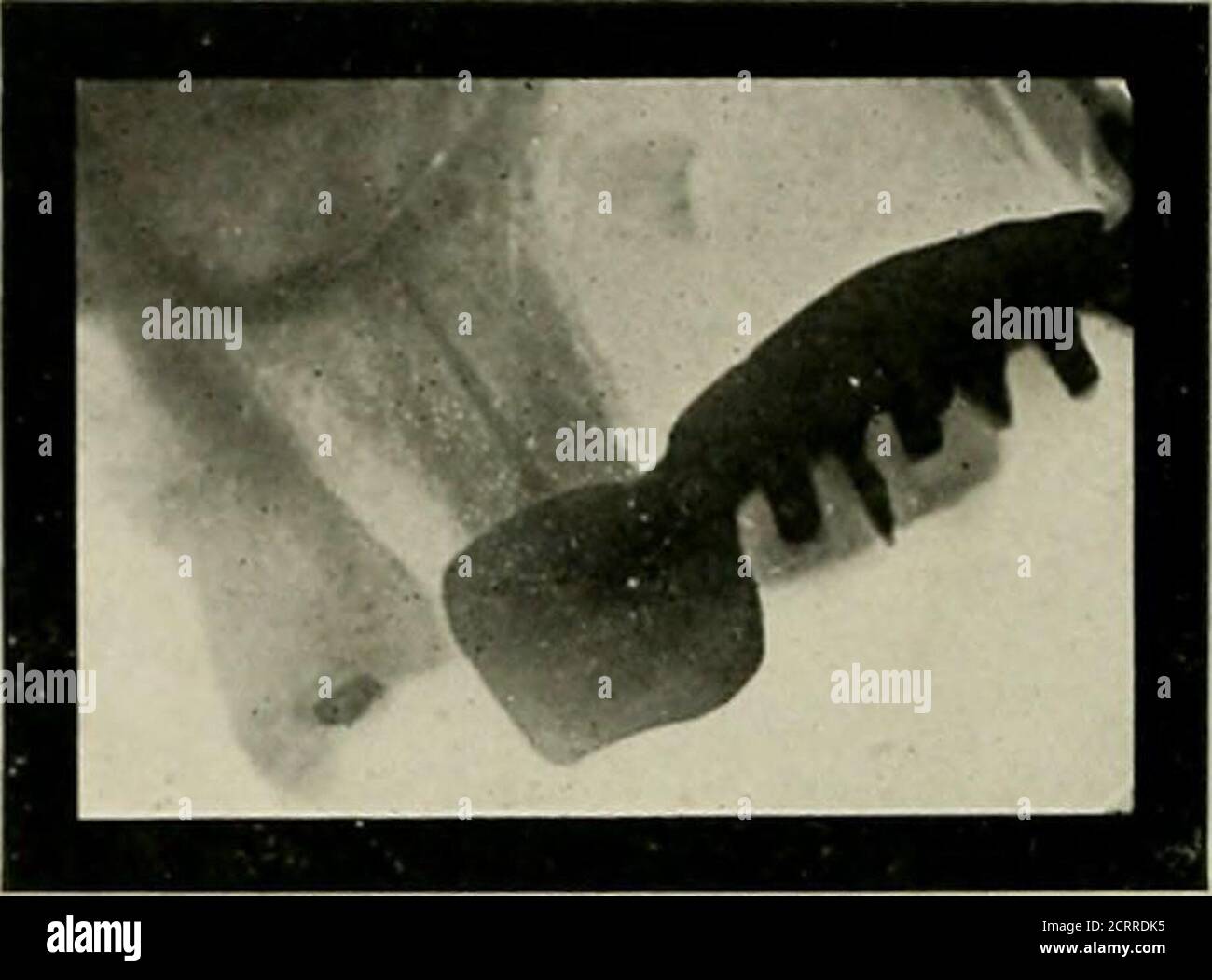 . Elementary and dental radiography . sis of the lower jawTi
