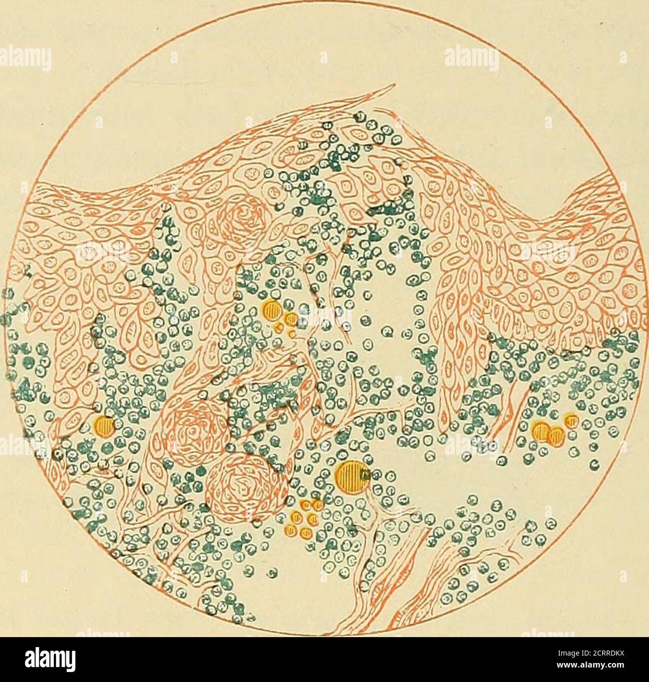 Throat lesions hi-res stock photography and images - Alamy
