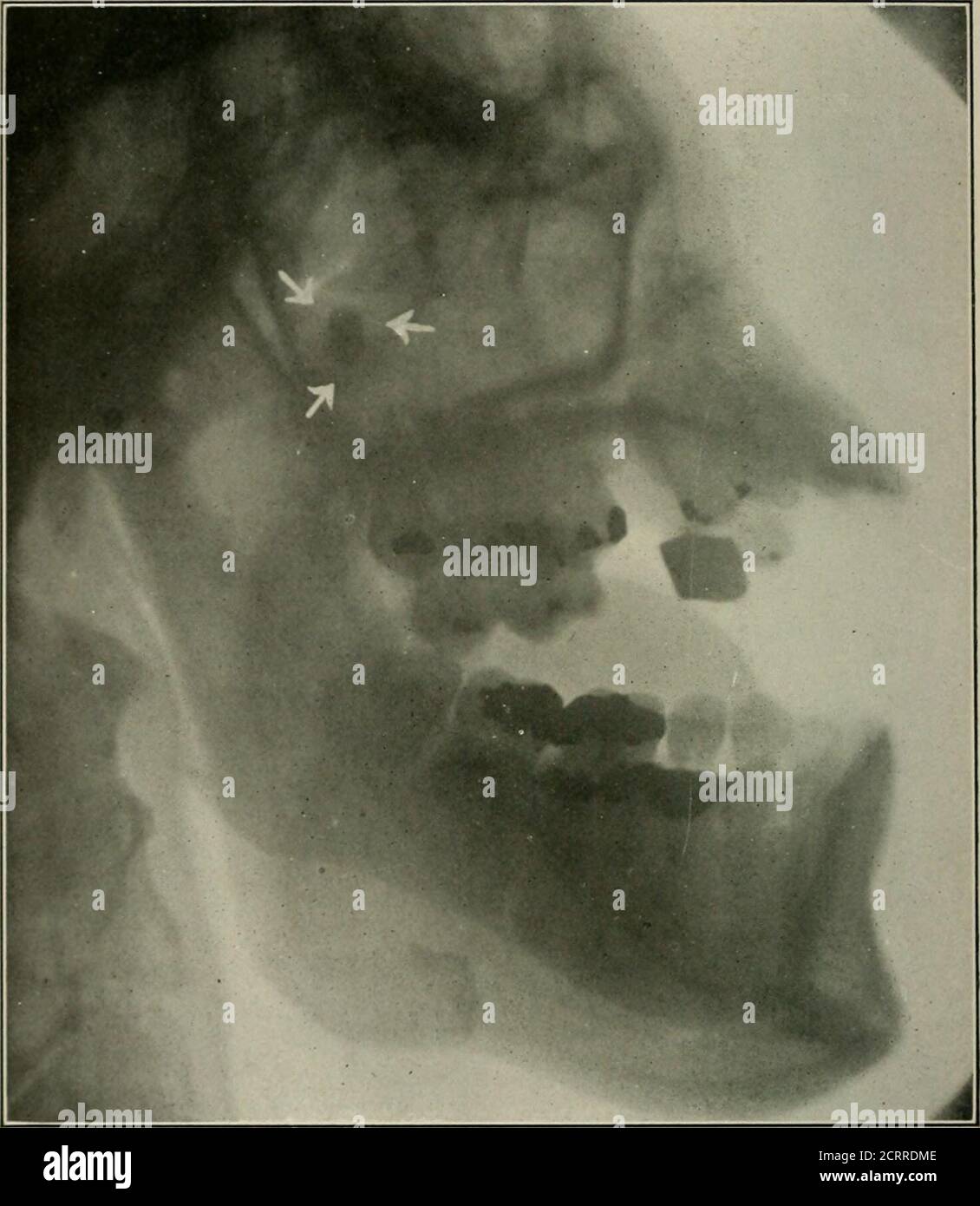 . Elementary and dental radiography . Fig. 276. The dots outline a very ...