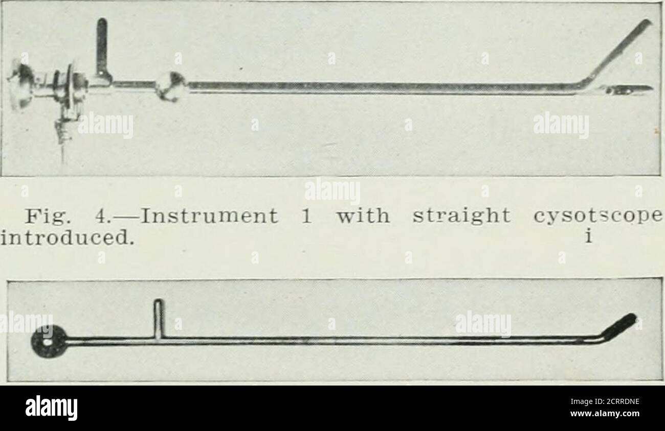 . Radium . Fie. 3.—Authors cystoscopic radium instrument1 carrying a ...