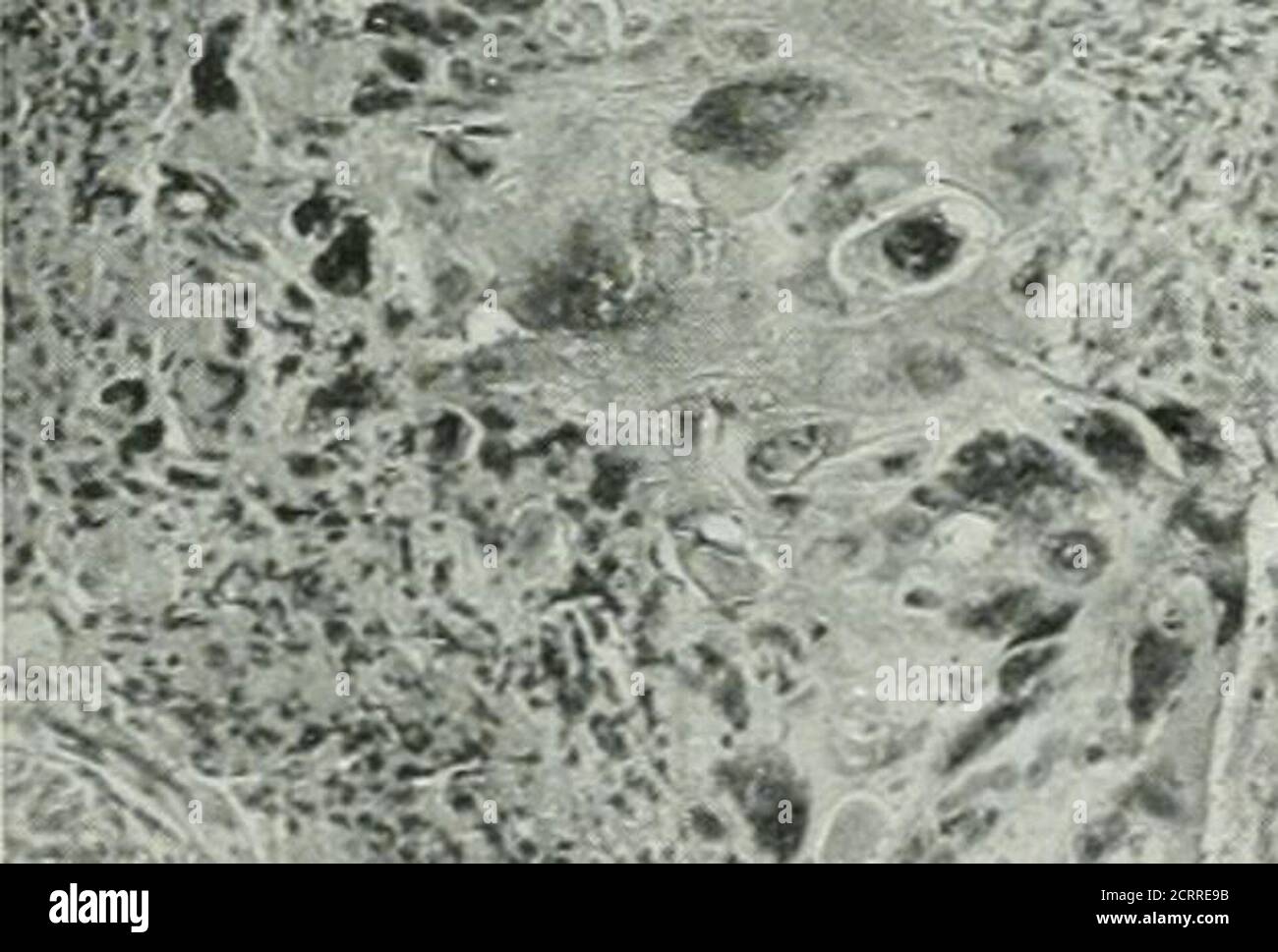. Radium . *• S^^ *»i». Fig. 4.—Epidermoid carcinoma of bladder ...