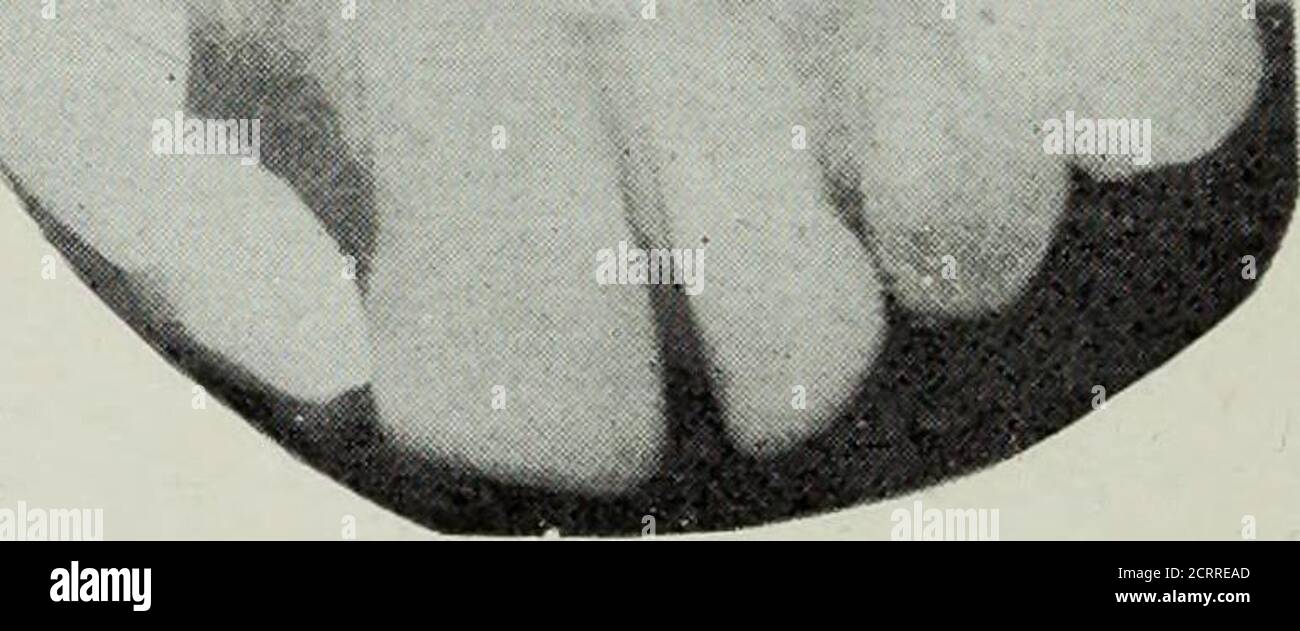 . Elementary and dental radiography . Fig. 109. Dental radiograph ...
