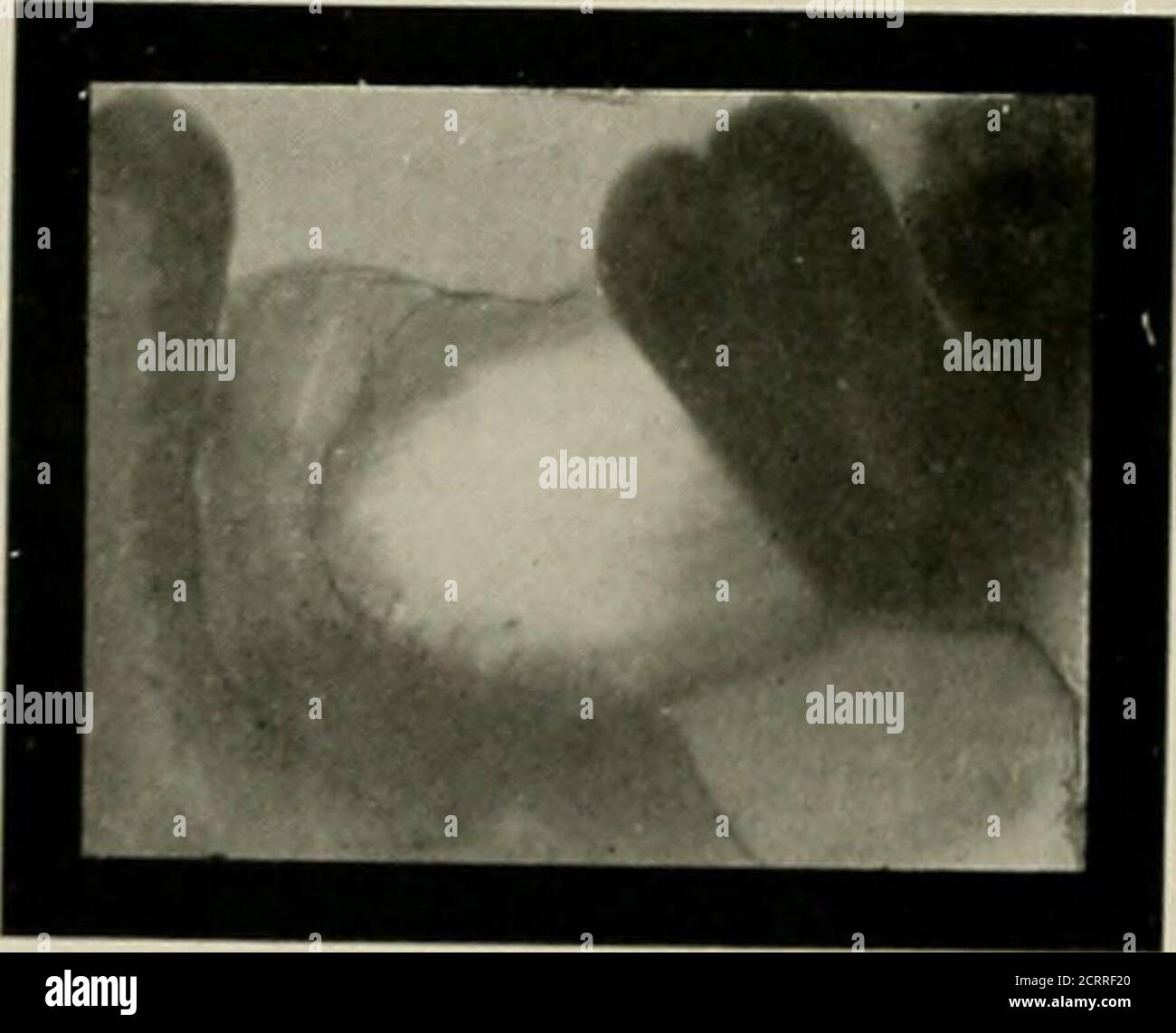 . Elementary and dental radiography . Fig. 252. Large cyst in the lower ...