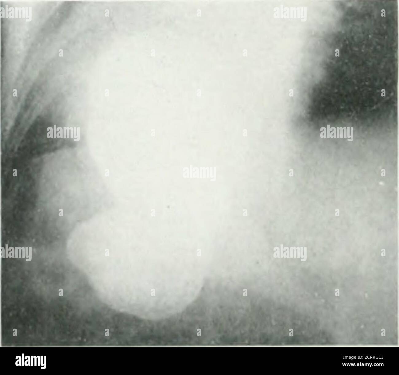 Talipes varus hi-res stock photography and images - Alamy