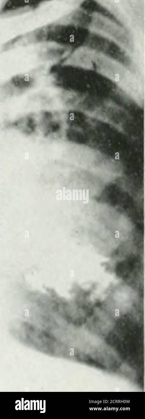 Esophageal abscess hi-res stock photography and images - Alamy